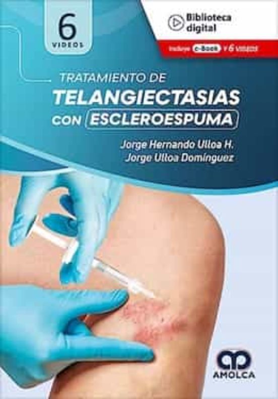 TRATAMIENTO DE TELANGIECTASIAS CON ESCLEROESPUMA | JORGE HERNANDO ULLOA ...